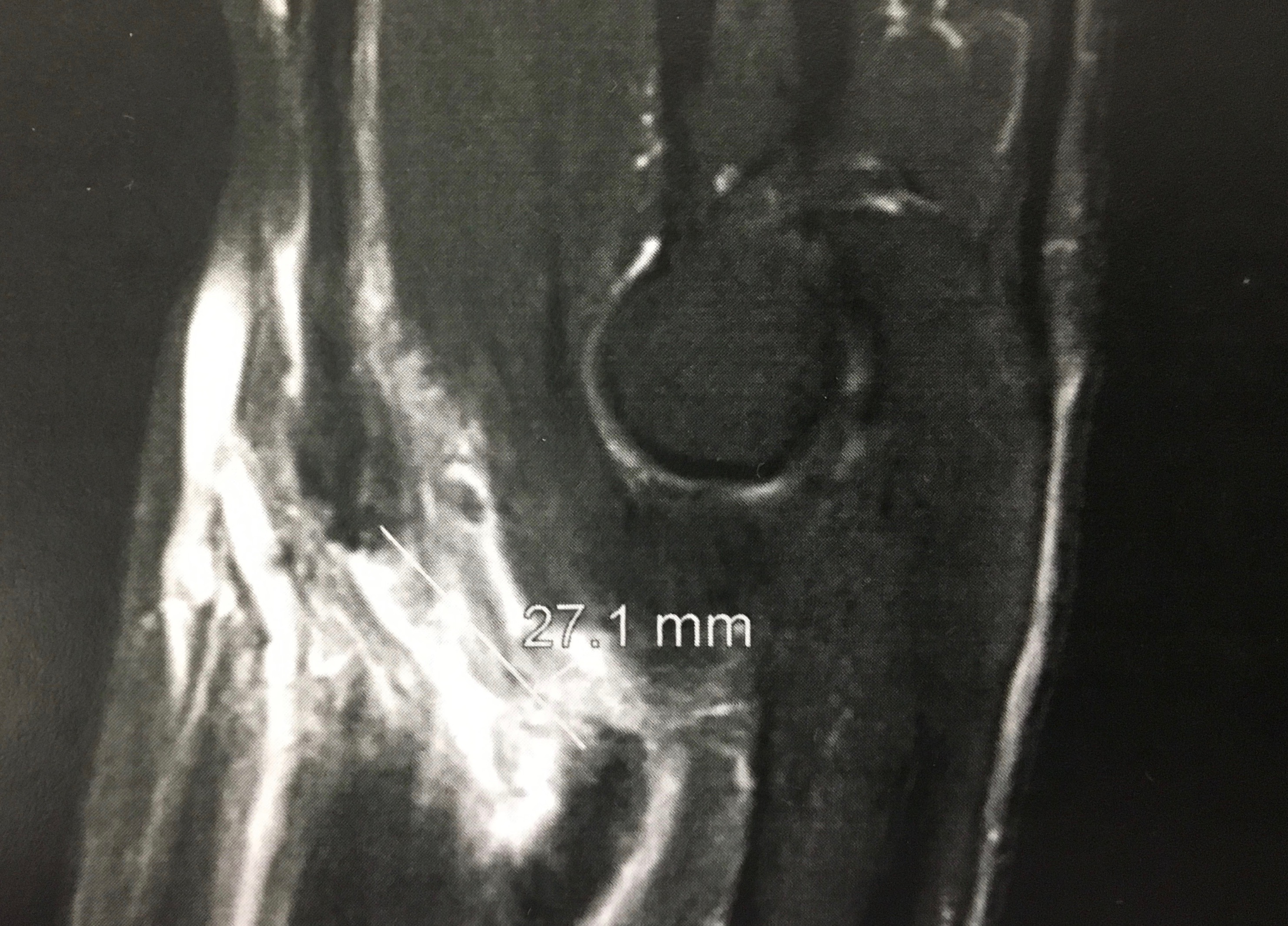 Rupture du biceps distal - Clinique Ostéo Articulaire des Cèdres - Grenoble